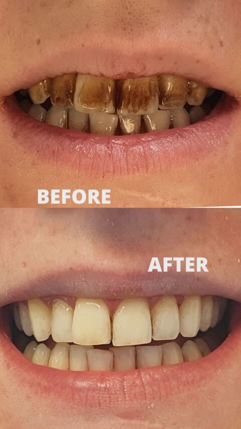 Airflow Teeth Cleaning Treatment | Airflow Dental Hygiene