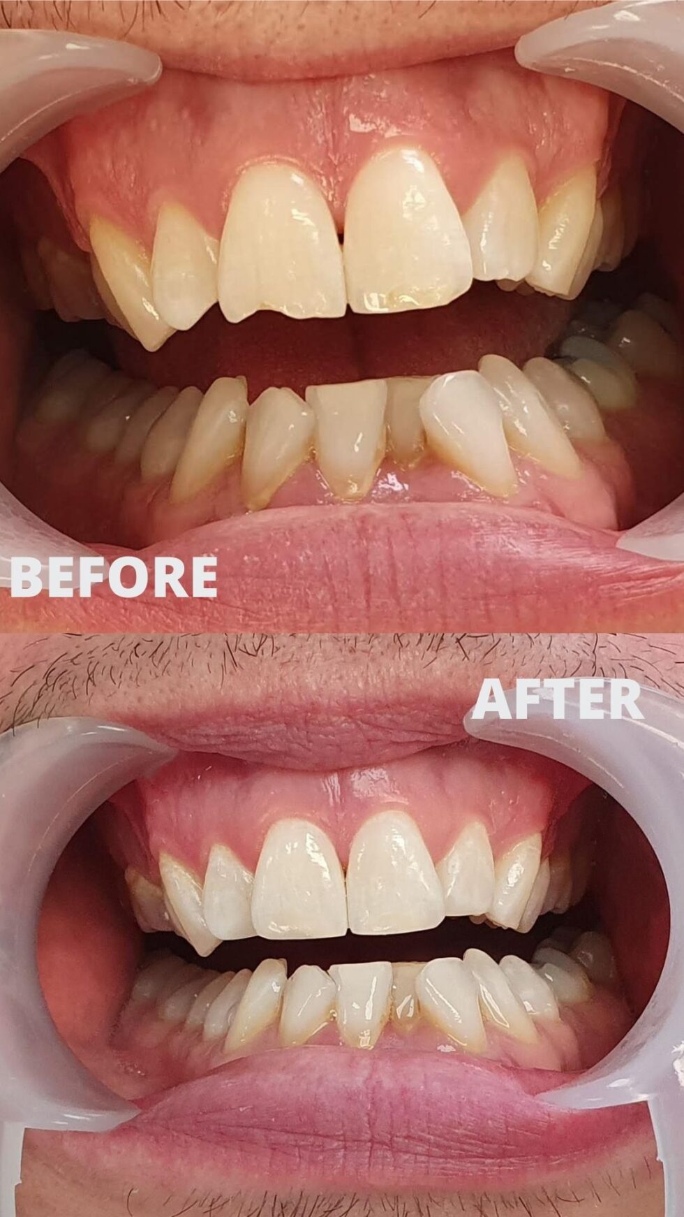 Composite Bonding Stoke-on-Trent | Dental Bonding