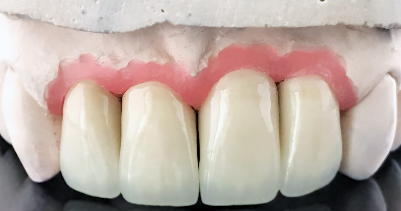 Treat Swollen Gums | Causes, Home Remedies & More